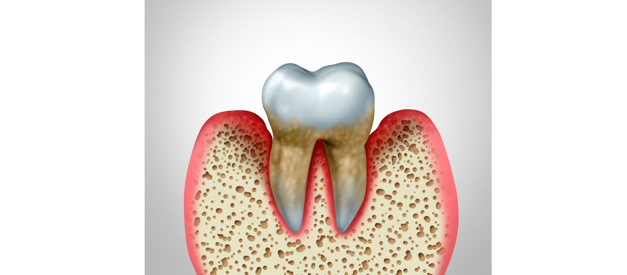 Periodontitt (Tannfestesykdom) - Sentrum Tannklinikk Larvik